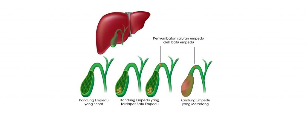 Batu Empedu: Penyumbat Saluran yang Dapat Menyebabkan Radang Kandung ...
