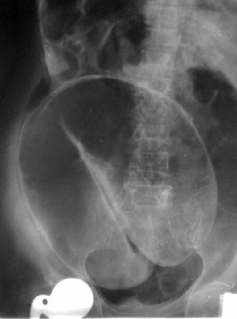 Volvulus: Ketika Usus Terpelintir dan Tersumbat – Laman 2 – Yayasan ...